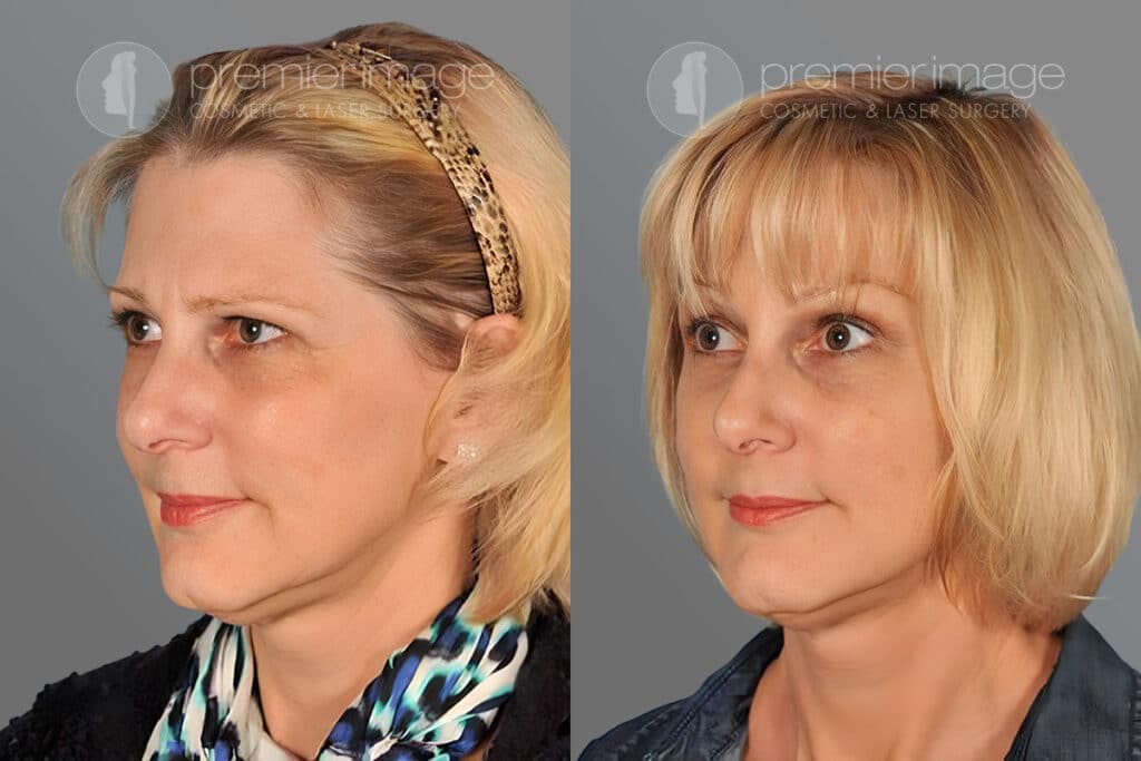 Brow Lift Recovery: Day by Day Timeline | Dr. Louis DeJoseph