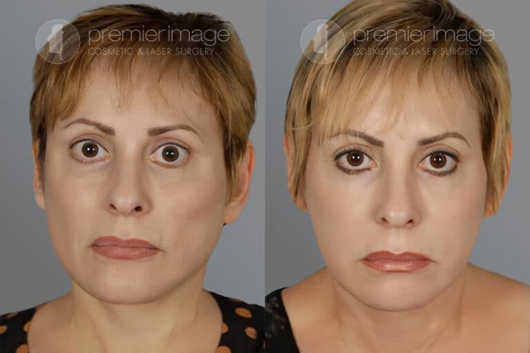 Botox Treatments in Atlanta, GA | Dr. Louis DeJoseph