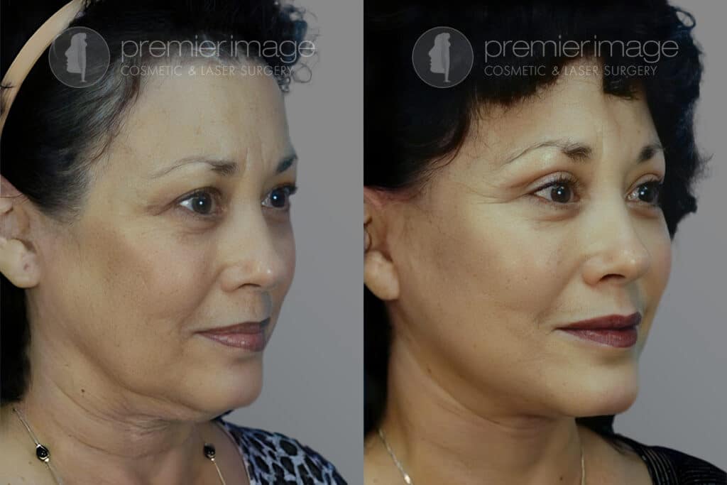 Healing from a Neck Lift: Managing Scars for Optimal Recovery