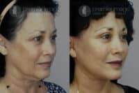 Healing from a Neck Lift: Managing Scars for Optimal Recovery