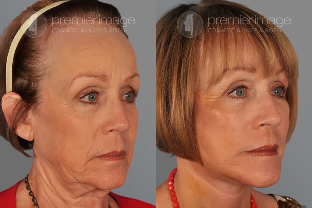 Healing from a Neck Lift: Managing Scars for Optimal Recovery