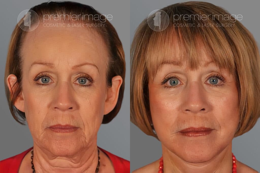 Guide to Navigating Your Neck Lift Surgery Recovery | Atlanta