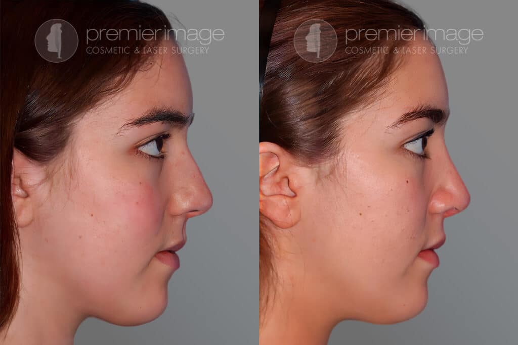 Refine Your Bulbous Nose Tip with Rhinoplasty